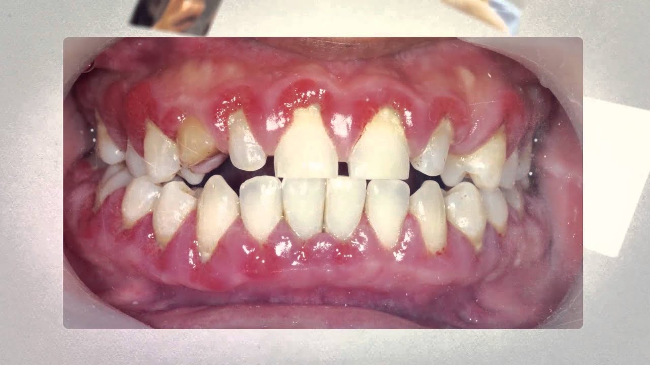 Dr. Lambert Lays Out Gum Disease Risk Factors