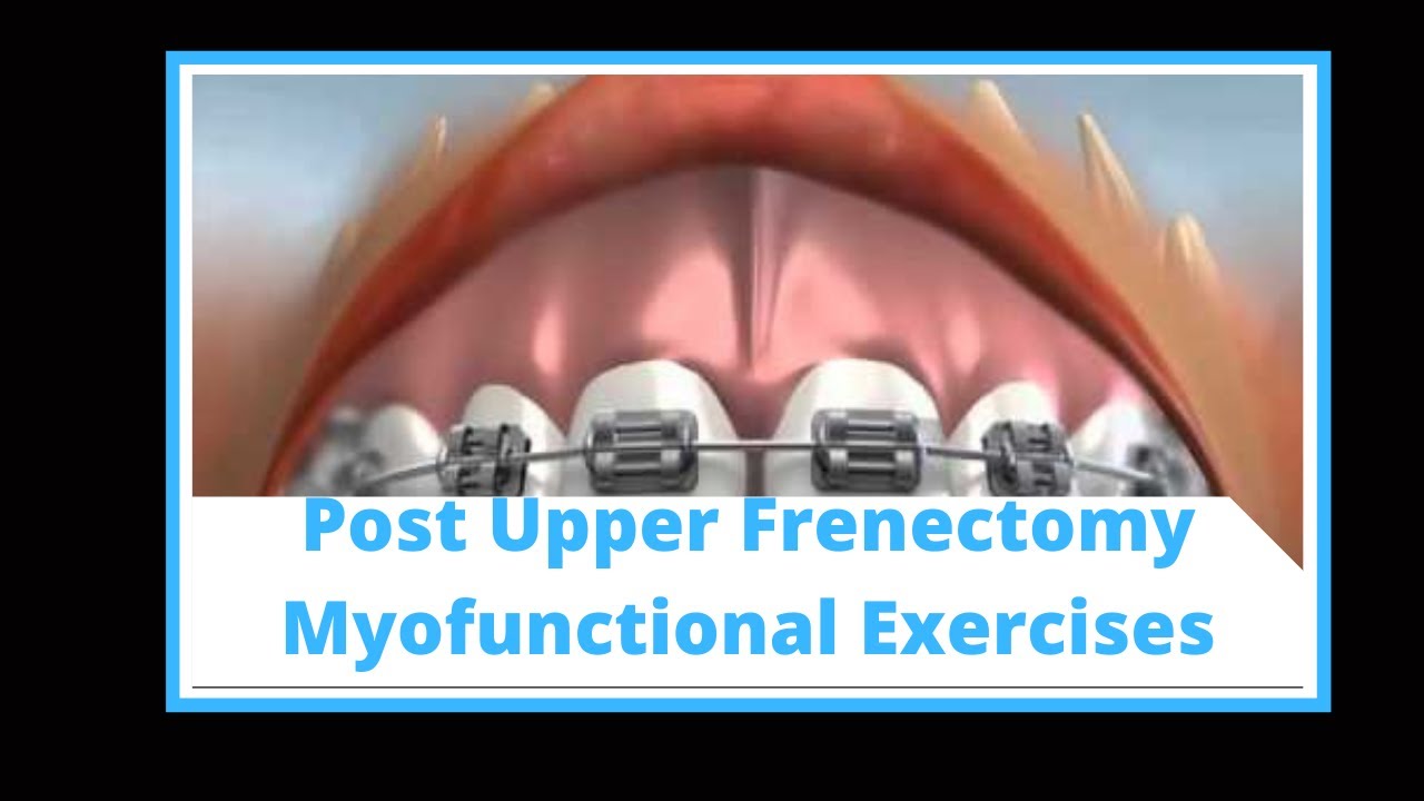 Post Upper Frenectomy Exercises