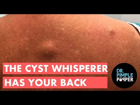 Dr. Pimple Popper pops 'pumpkin' epidermoid cyst in YouTube Video