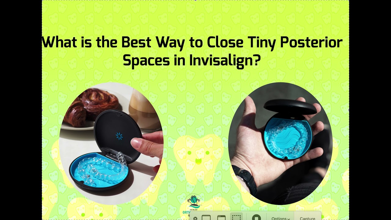 How to Close Tiny IPR Spaces in an Invisalign Refinement- Virtual IPR