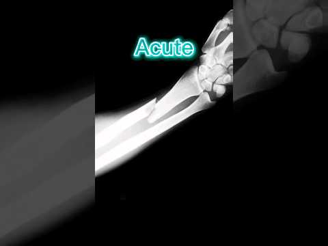 ACUTE - MEDICAL DEFINITION | Medical Consecutive Interpreting