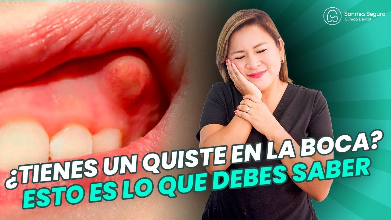 Dental Cysts: The Silent Enemy 🤫🦠