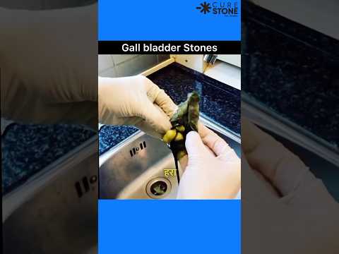 Gall bladder Stones | Laproscopic cholecystectomy | How gall bladder stones are removed