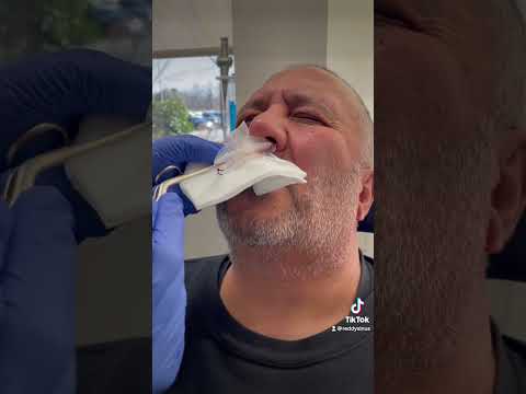Removal intransal splints after septoplasty for deviated septum.