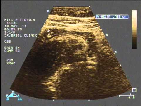 obstructive appendicitis.mpg