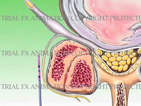 Discogram and Rhizotomy Procedure