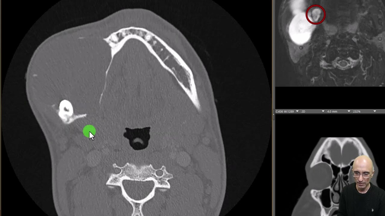 Ameloblastoma