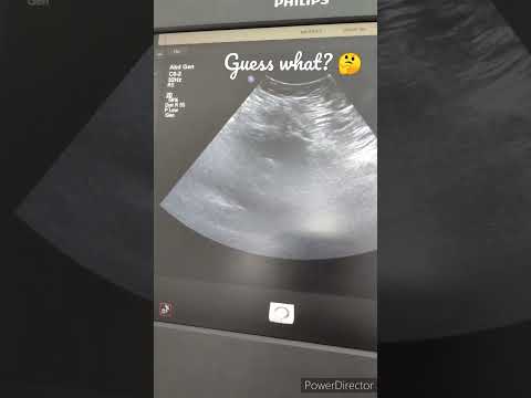 A foley's catheter with full bladder in bedside USG? What may be the cause of full bladder?#shorts