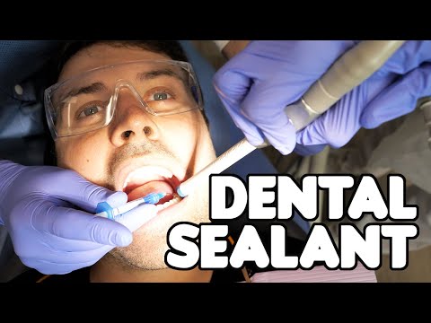 Dental Sealant Procedure