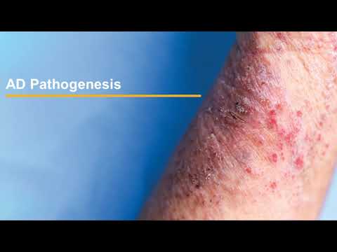 Atopic Dermatitis: Strategies to Improve Outcomes (Adult: Mild-Moderate Severity)