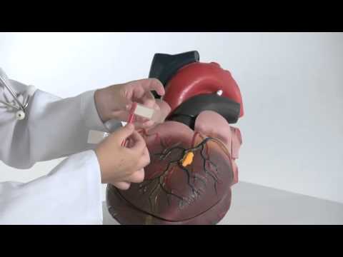 Kidz Explain- EPISODE 4 'What is a Coronary Artery Bypass Graft?'