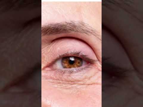 #Meaning of Blepharoptosis#Ptosis and it's causes