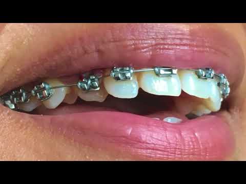 Tooth Impaction: Teeth Trapped In The Gums | Esi Orthdontics Blog