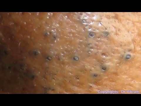 99 Pimples and a Zit Ain't One!