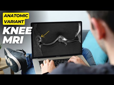 Anatomic Variant in Anteromedial Corner of the Knee on MRI.
