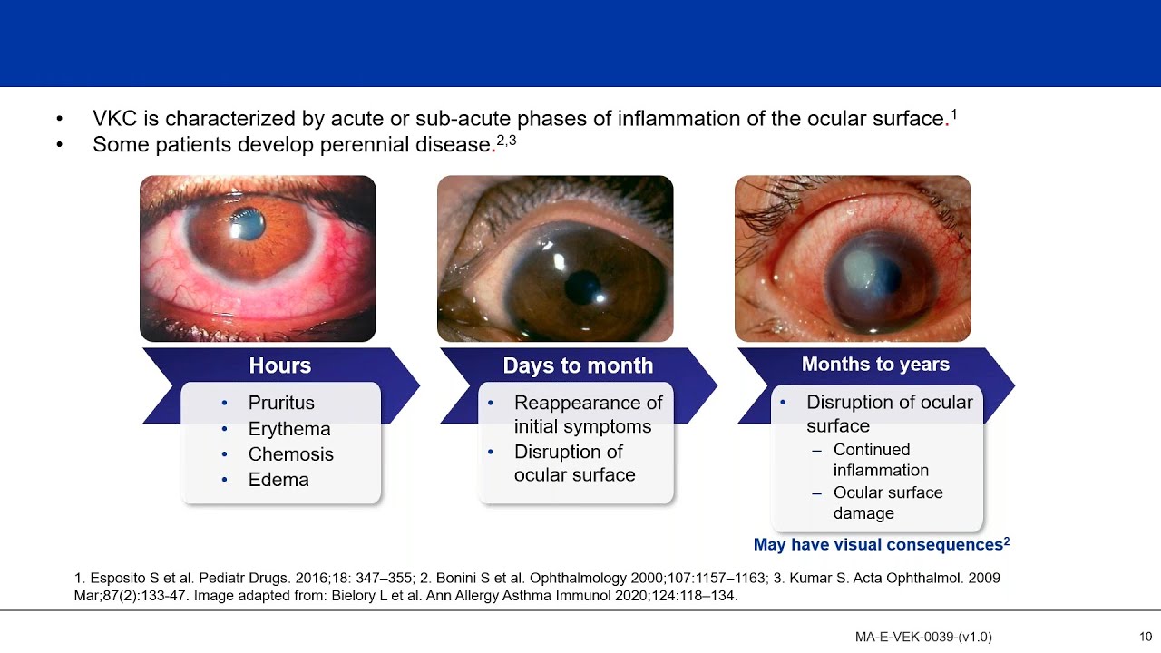Understanding Vernal Keratoconjunctivitis (VKC): Not “Just an Allergy”