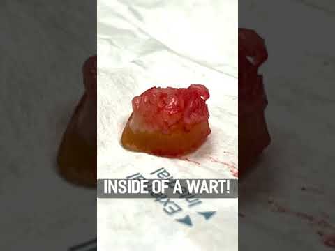 INSIDE OF A WART!😳🤯 #shorts #wow