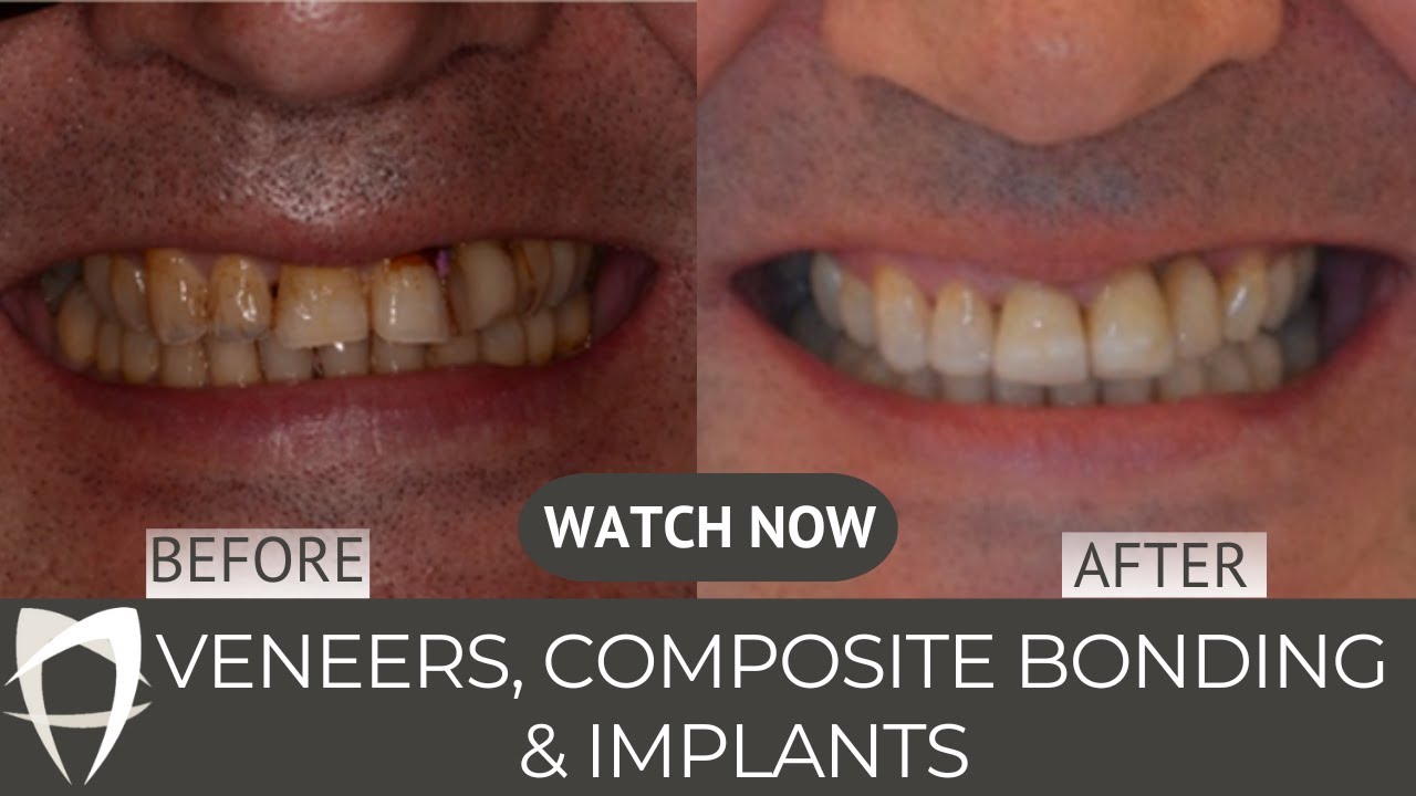 Cosmetic Dentistry | Veneers, Composite Bonding and Implants Case Presentation