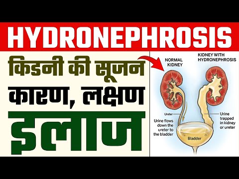 Hydronephrosis in Kidney | किडनी में सूजन के कारण, लक्षण और इलाज | DR Puru Dhawan