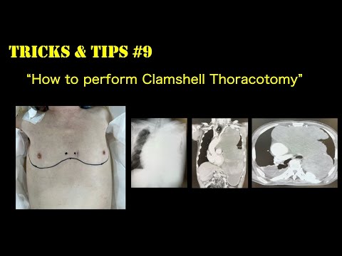 【Tricks & Tips 9】How to perform the clamshell thoracotomy (2X video).