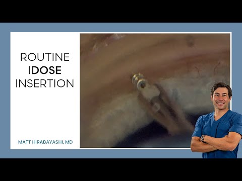 Routine iDose Insertion with Cataract Surgery