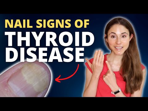 What Your Nails Say About Your Thyroid