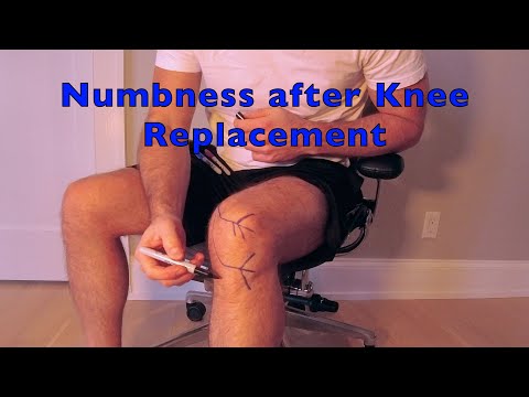Numbness after total knee replacement surgery
