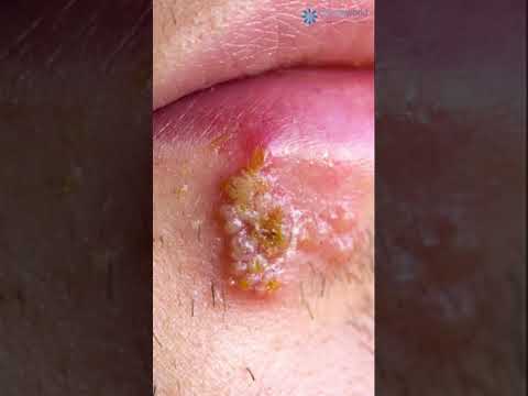What is Herpes Labialis? | What is the reason for Herpes Labialis? | Dr. Rohit Batra Explains