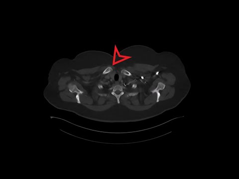Chest CT: Subtle Right Anterior Sternoclavicular (SC) Dislocation