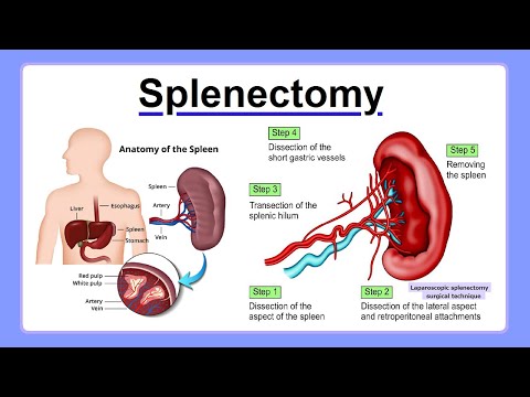 splenectomy