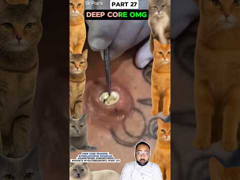 Deep Core Trapped #pimplepopper #pimples #shortsfeed #shortvideo #shorts #youtubeshorts (Part 27)