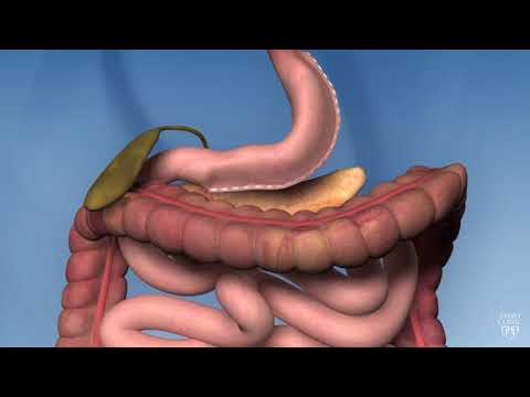 Sleeve Gastrectomy