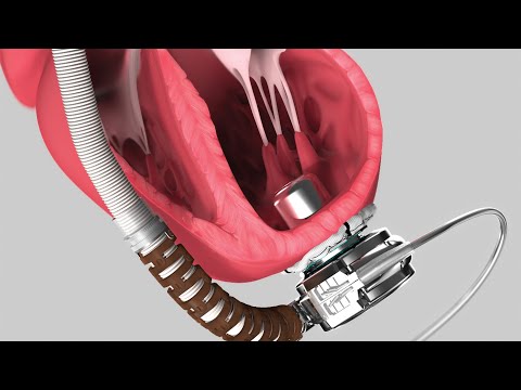 Medical Device Animation: Heartware System LVAD Pump