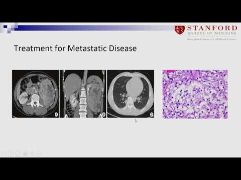 Overview of RCC treatment - Brian Dietrich, MD