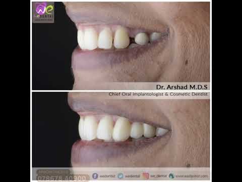 Smile Design| Smile Makeover| We Dental| Dr Arshad| Cosmetic Dentistry| Esthetics| Zirconia| Emax
