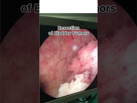 Endoscopic Removal of Bladder Tumor