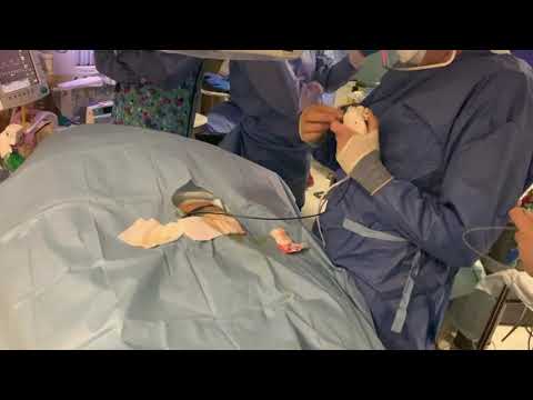 ERCP Cutting Edge: Percutaneous Cholangioscopy with SpyGlass Discover