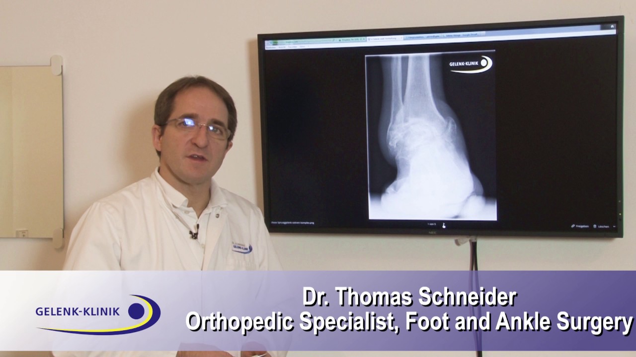 Ankle prosthesis surgery in an arthritic ankle with severe deviation