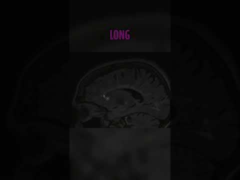 Multiple Sclerosis MRI Shows Severe Brain Damage