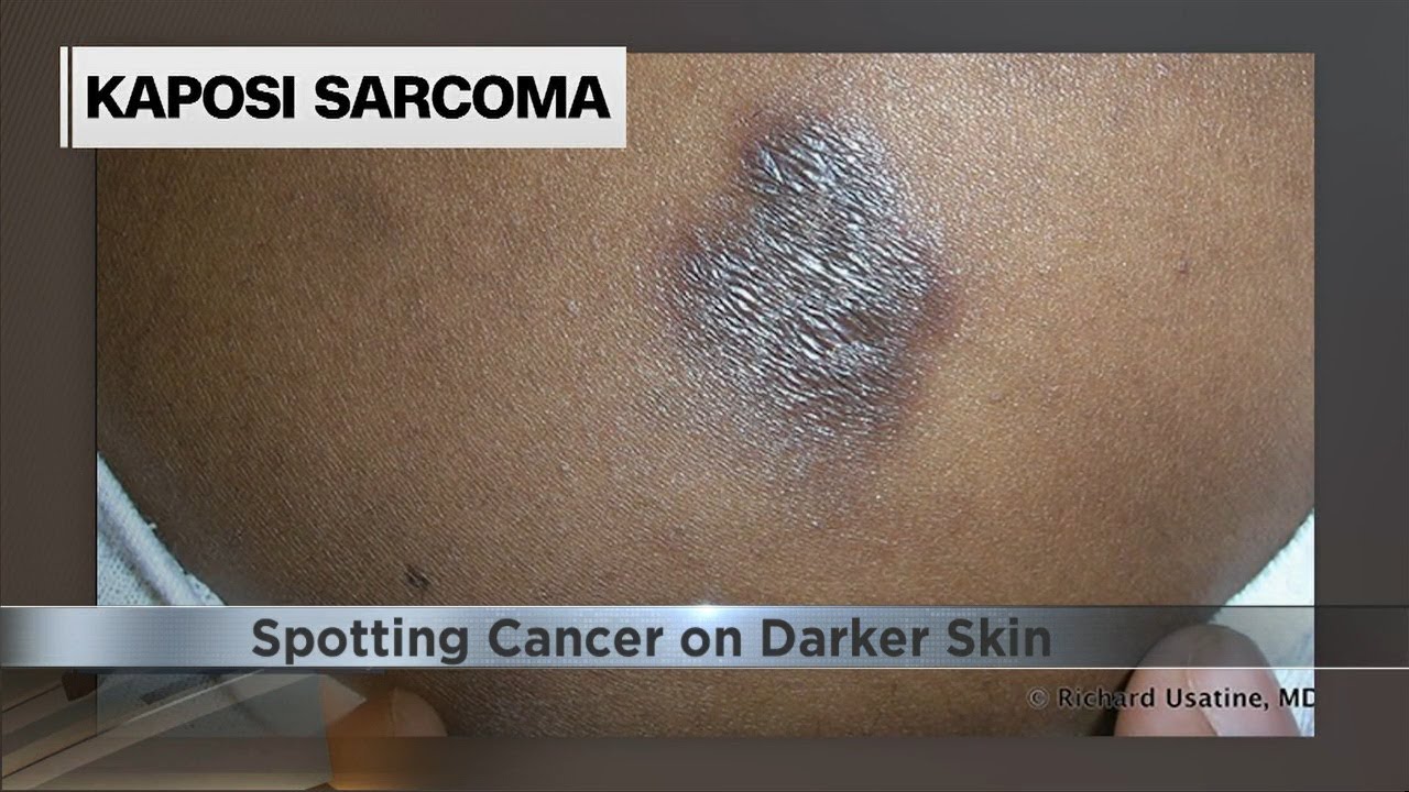How to spot melanoma and other cancers on darker skin