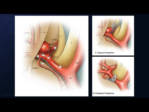 Clipping of Ruptured Anterior Communicating Artery Aneurysms with Repair of an ICA Tear