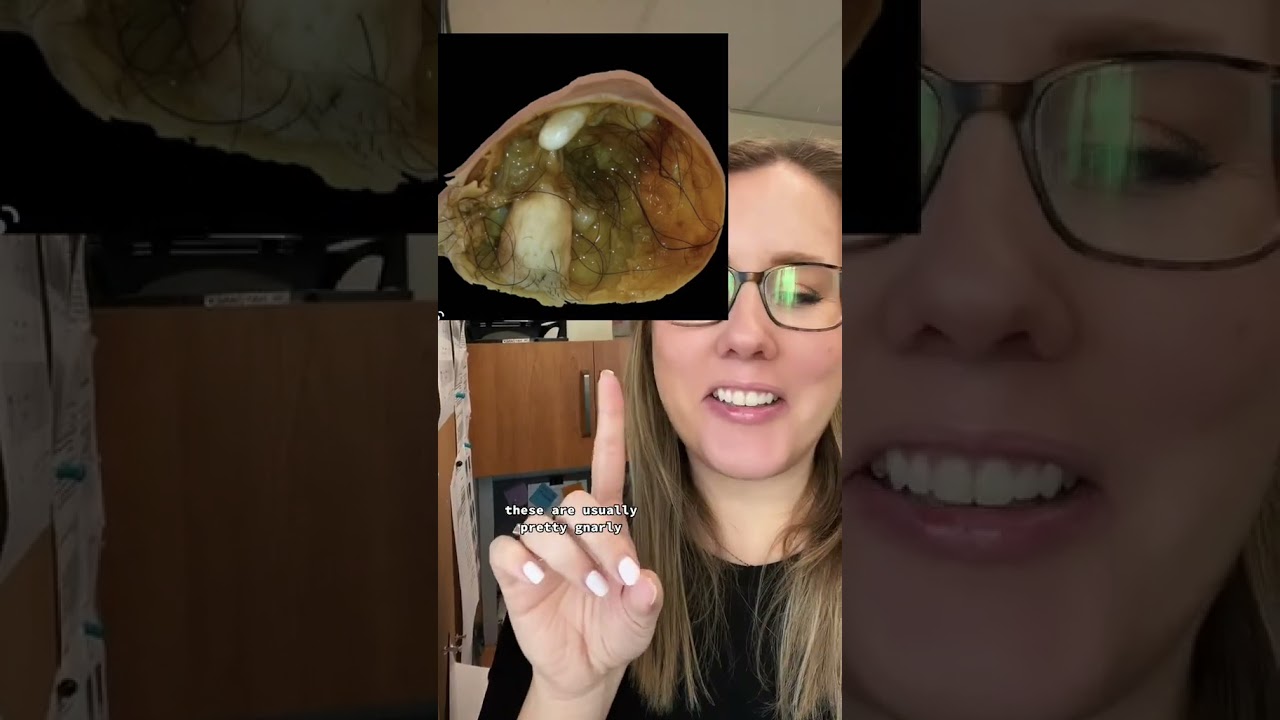 a teratoma that grows hair and teeth?!