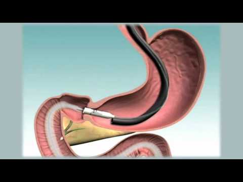 Alex Escalona, MD: Xtreme Endoscopic Toolbox: New and Cutting Edge Therapies (English)
