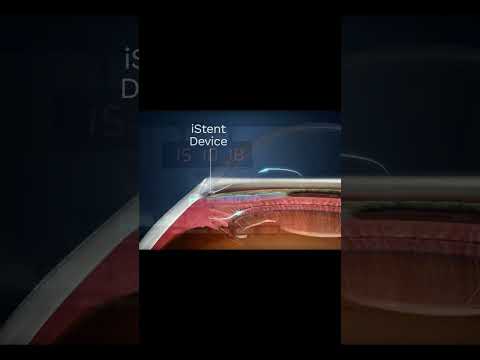 Can you tell me what treatment is recommended for pseudoexfoliation glaucoma?