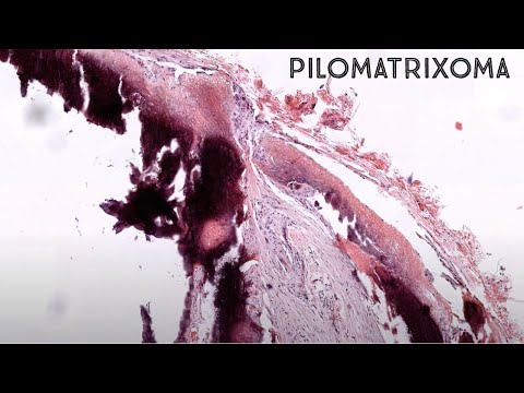 Pilomatrixoma under the microscope (with calcification & metaplastic bone ossification) pathology
