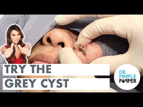 Dr. Pimple Popper Pops A 'Cream Filling' Face Cyst In Youtube Video