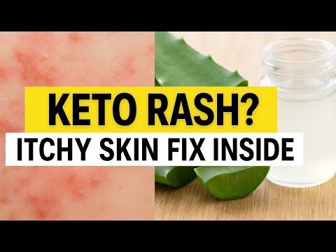 “The Ugly Side of Keto: What Causes Keto Rash & How to Heal Naturally”
