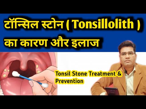 What are TonsiIIoliths Cause Symptoms and Treatment | (Tonsil Stone )
