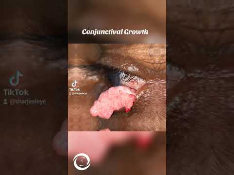 Conjunctival Growth