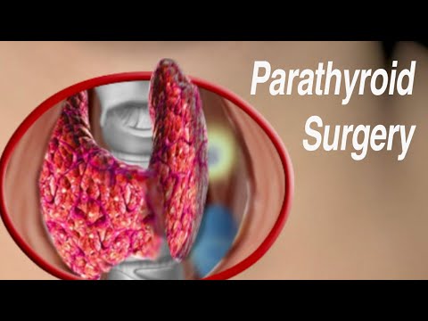 Parathyroid Surgery: Traditional Open and Minimally Invasive Approaches